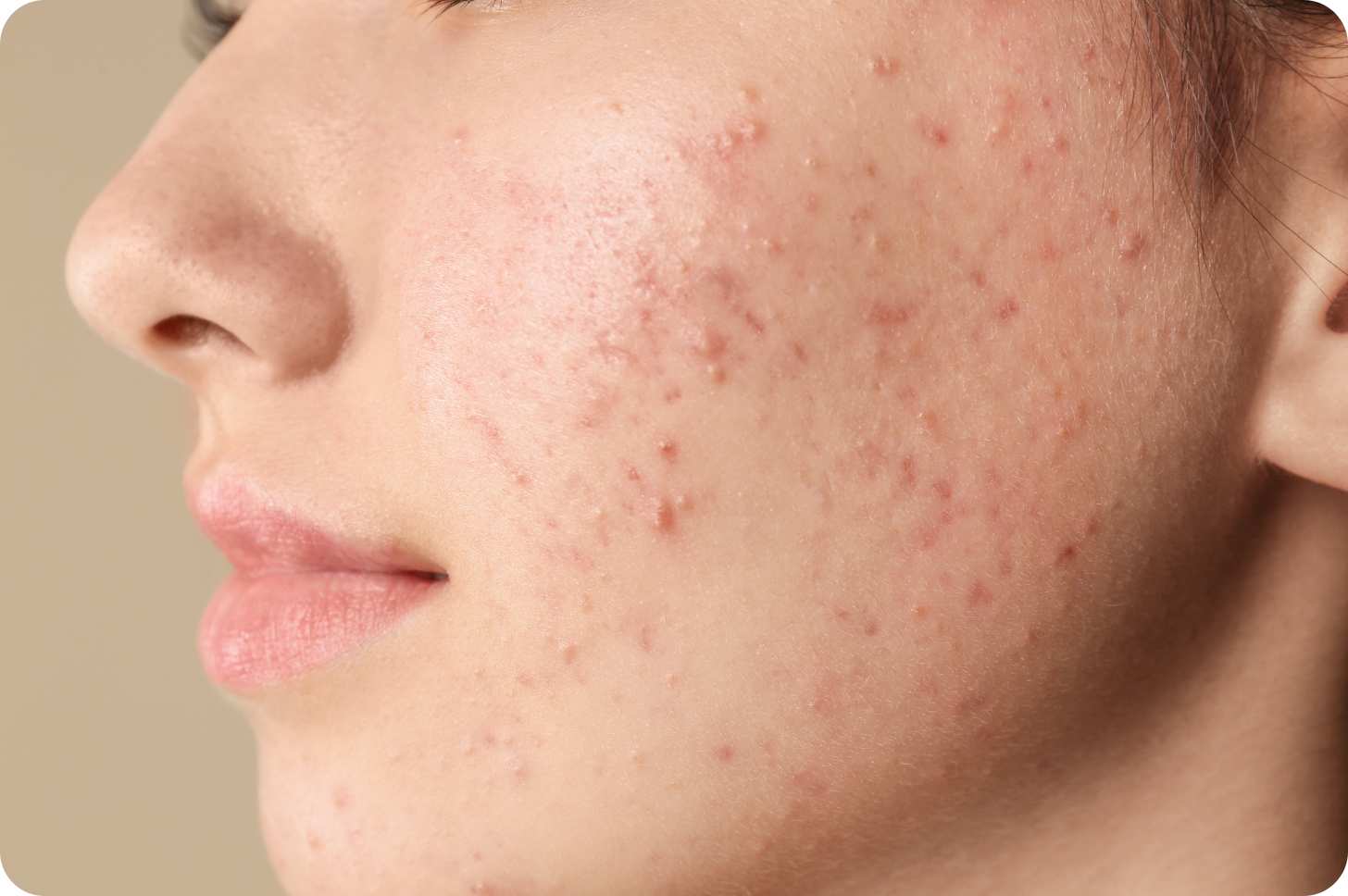 10 Acne Fighter Paling Populer di Indonesia - KOL.ID
